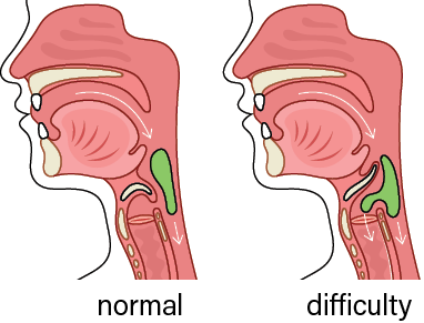 Swallowing Problems? - Treyton Oak Towers